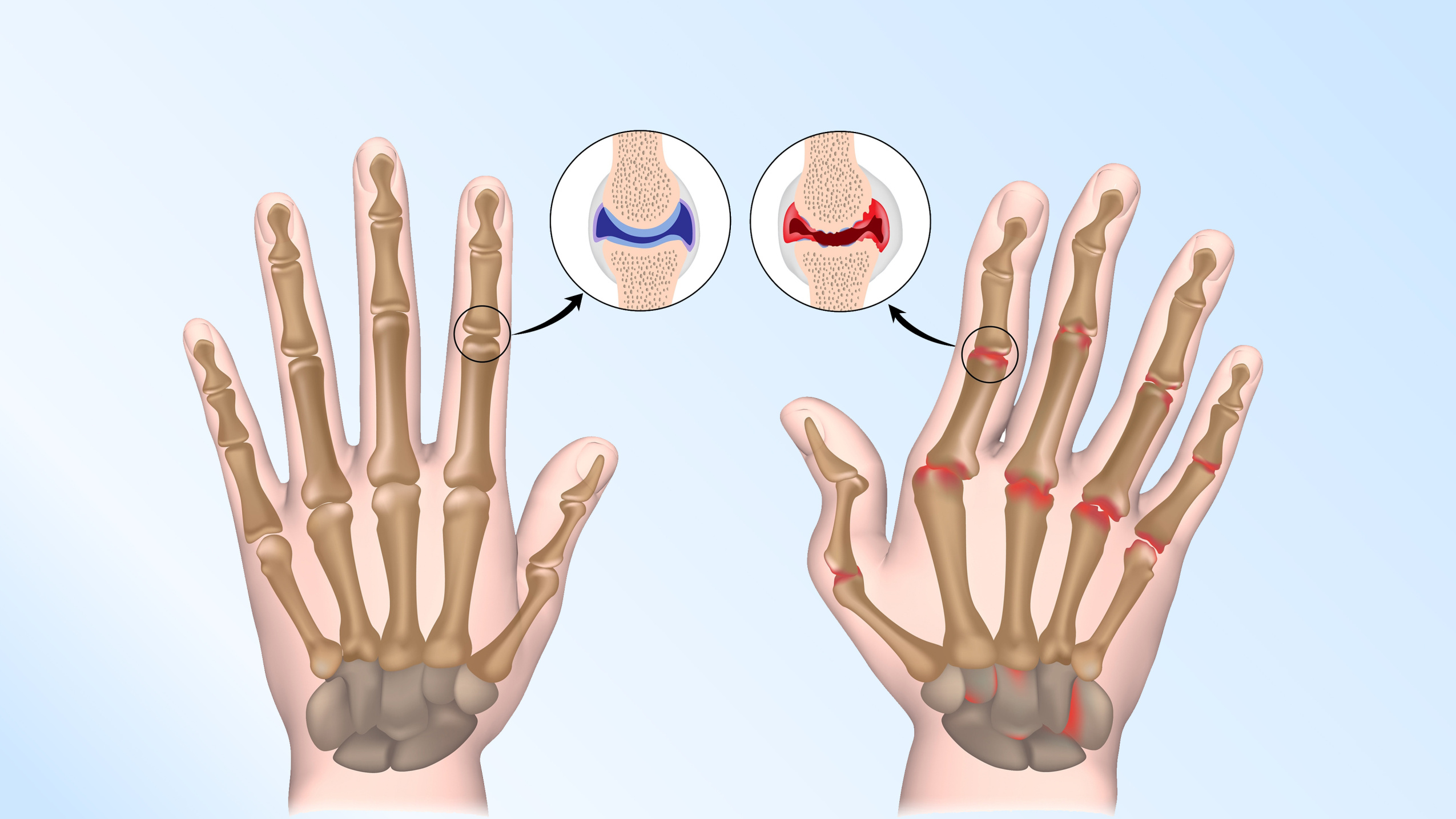 Artritis reumatoide: ¿Tratamiento común o cura definitiva?